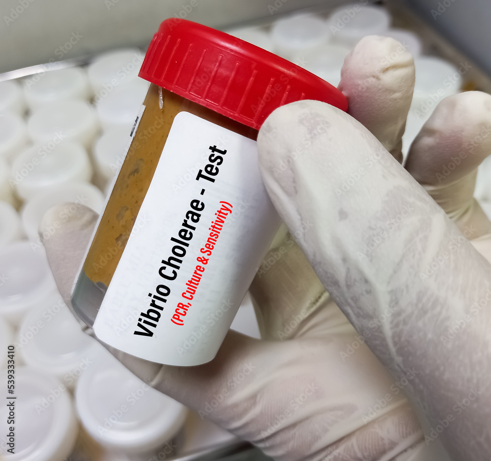 Stool sample for Vibrio cholerae(PCR and Culture) test, for diagnosis ...