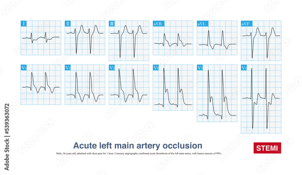Acute left main artery occlusion can cause both ST segment elevation ...