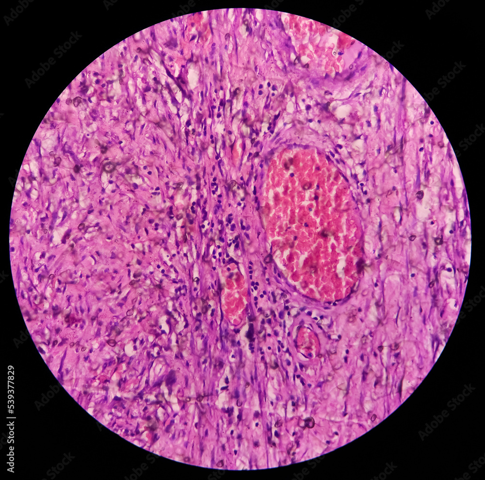 Testis biopsy, testicular infarction, disease of male genital organs ...