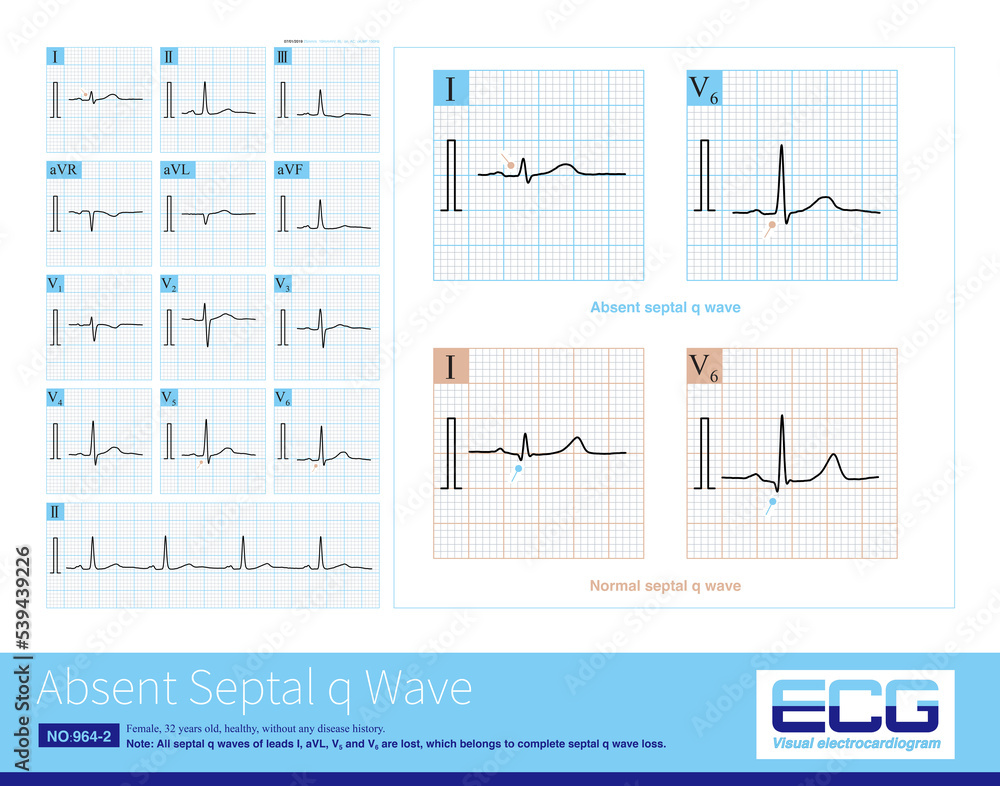 The absent septal q wave in ECG may be a normal variant, and the ...