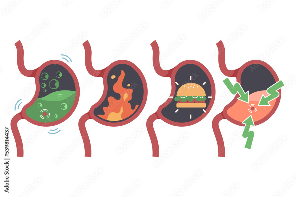 Gastric bloating vector cartoon set isolated on a white background ...