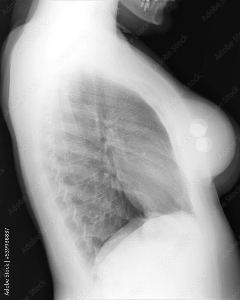 Lateral Chest X Ray Of A Woman With Breast Expanders Following Breast