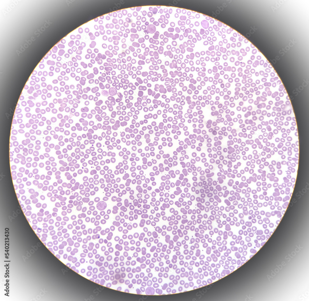Essential thrombocytosis blood smear, present abnormal high platelet ...
