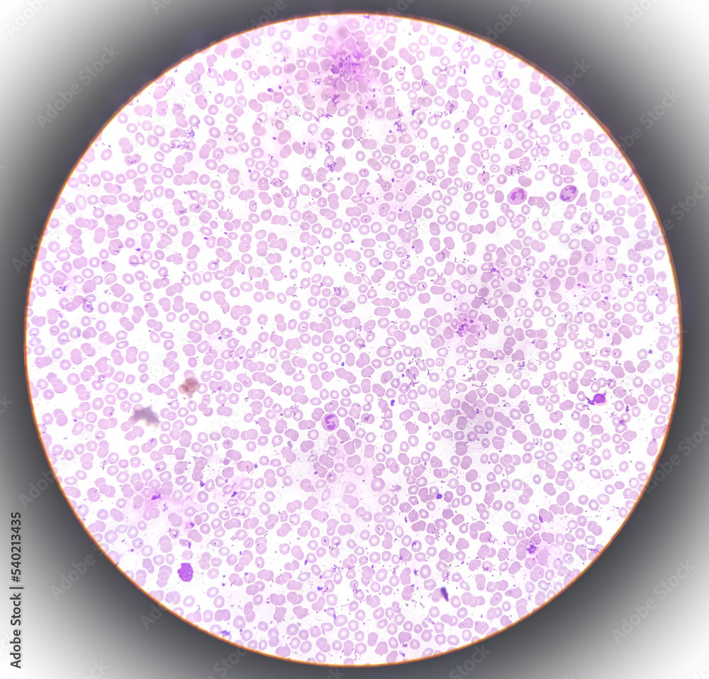 Essential thrombocytosis blood smear, present abnormal high platelet ...