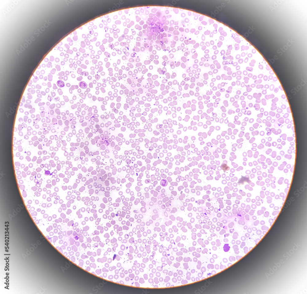 Essential thrombocytosis blood smear, present abnormal high platelet ...