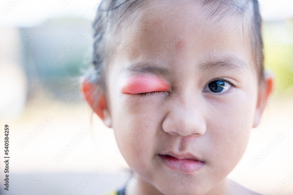 Stye Eye diseases. Closed Asian kid little girl eye with sty, eyelid ...