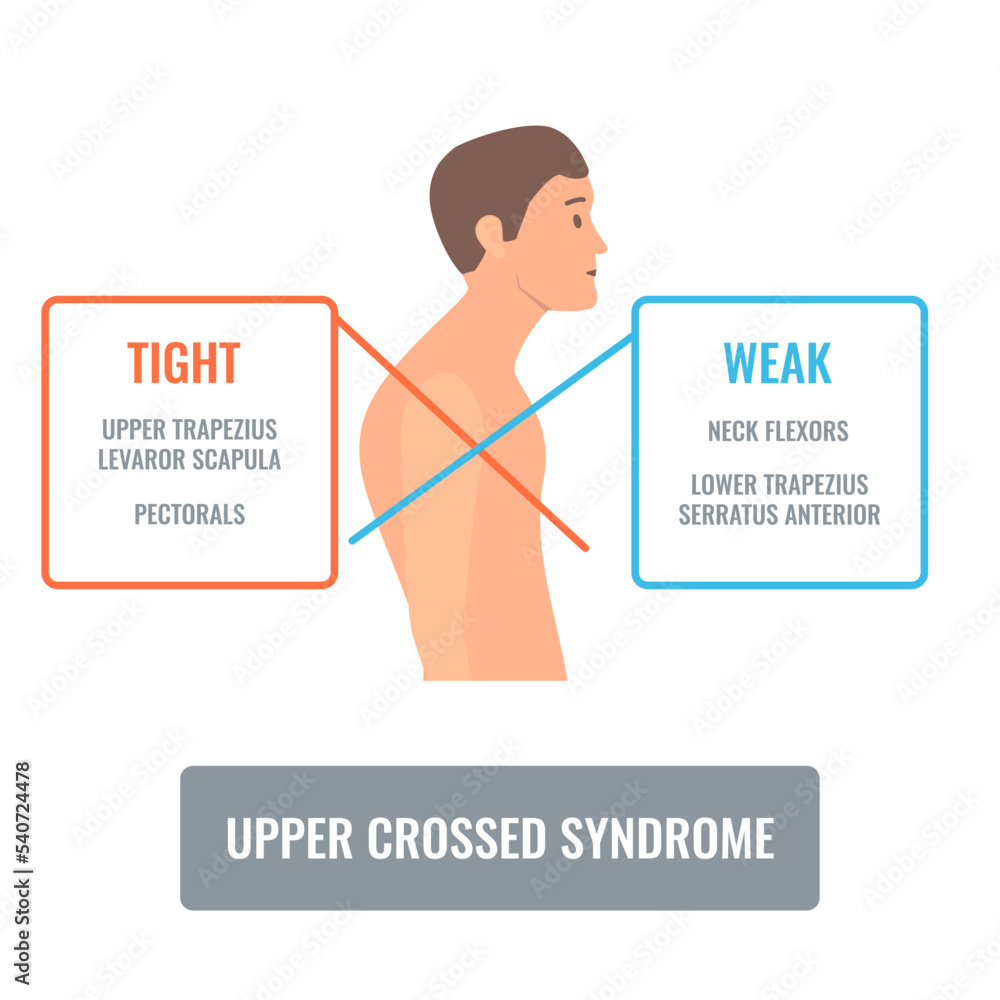 Upper crossed syndrome medical diagram. Crooked man with muscle ...