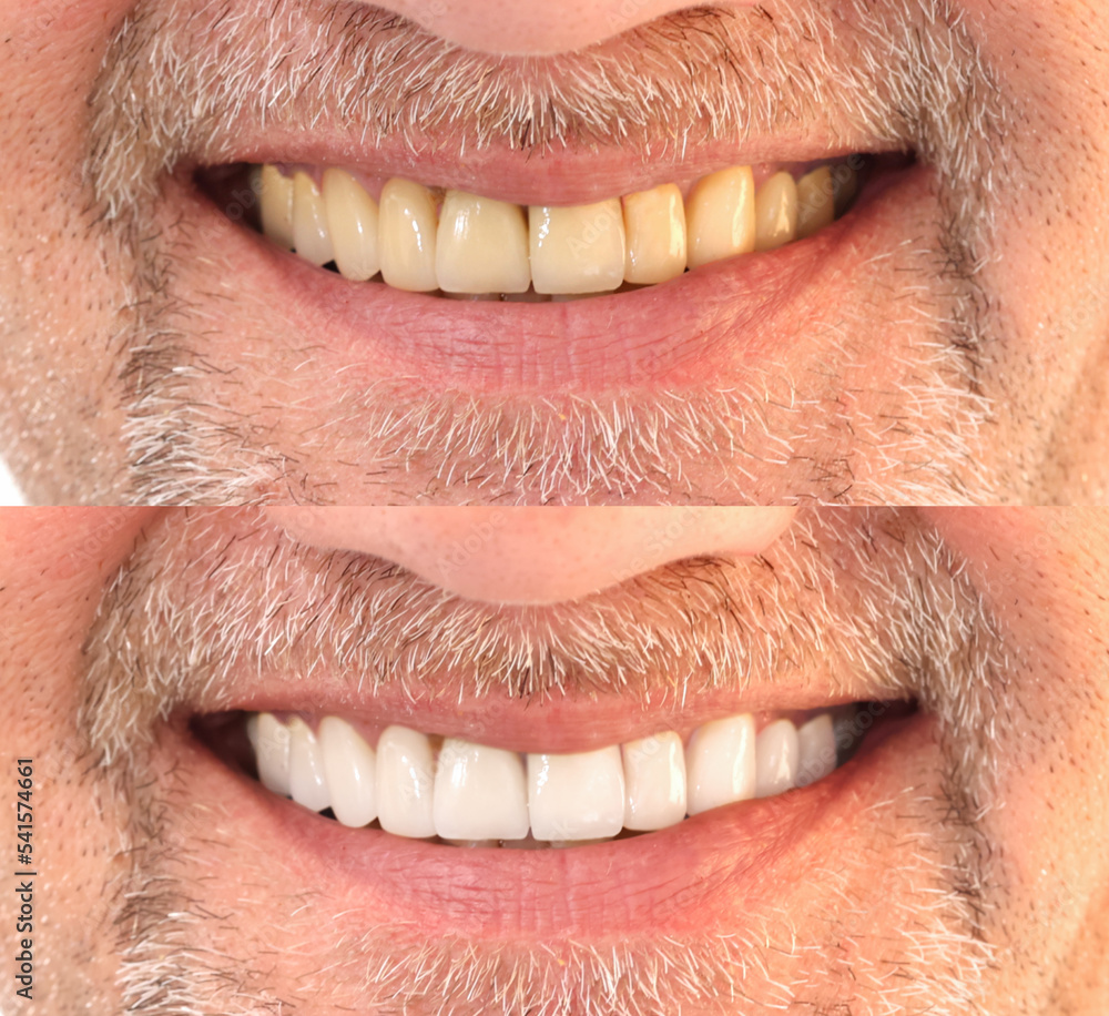 Closeup smiling caucasian man Teeth comparison Before and After teeth ...