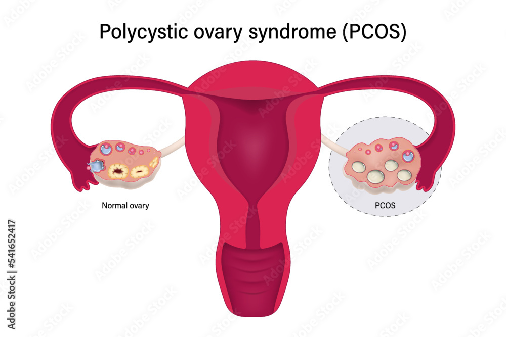 Polycystic ovary syndrome PCOS. Multiple immature follicles vector. Ovarian cysts with female ...
