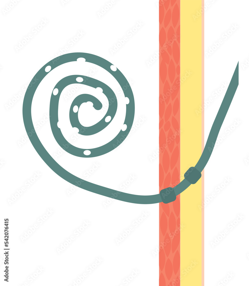 Peritoneal Dialysis Catheter illustration. Subcutaneous and deep cuff ...
