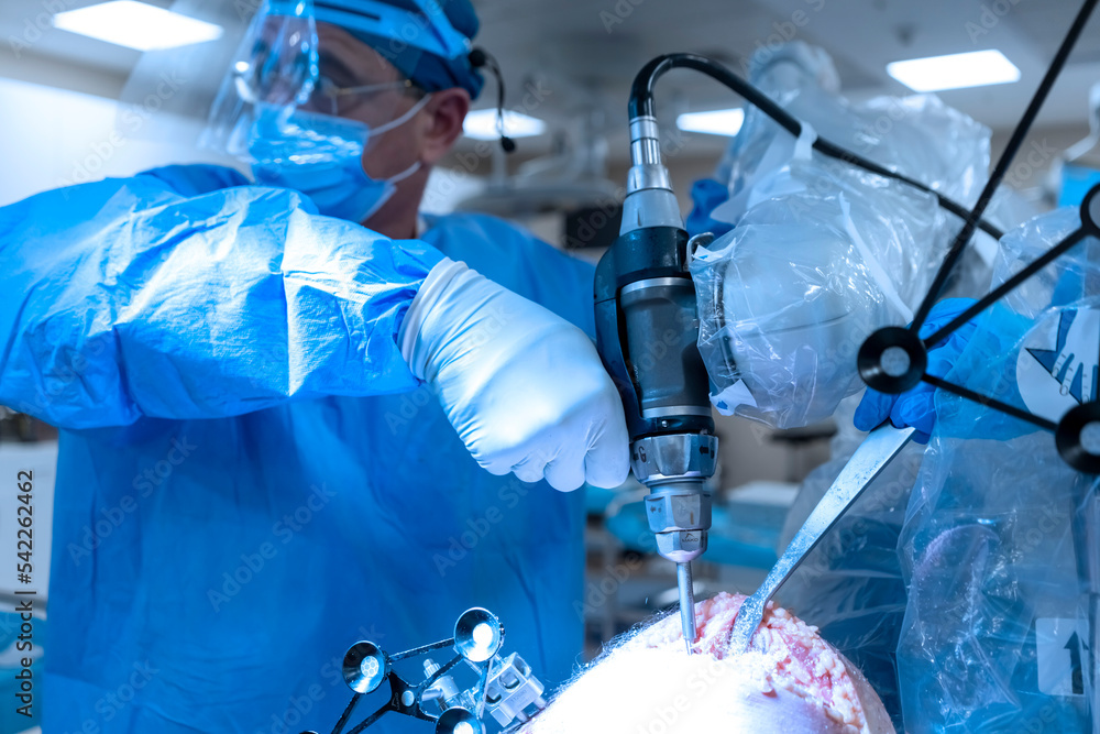 Team of doctor perform total hip arthroplasty replacement surgery in ...