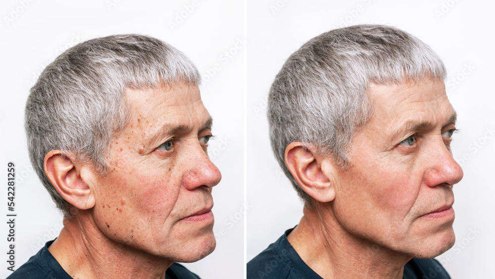 Elderly caucasian man before and after getting rid of moles and age ...