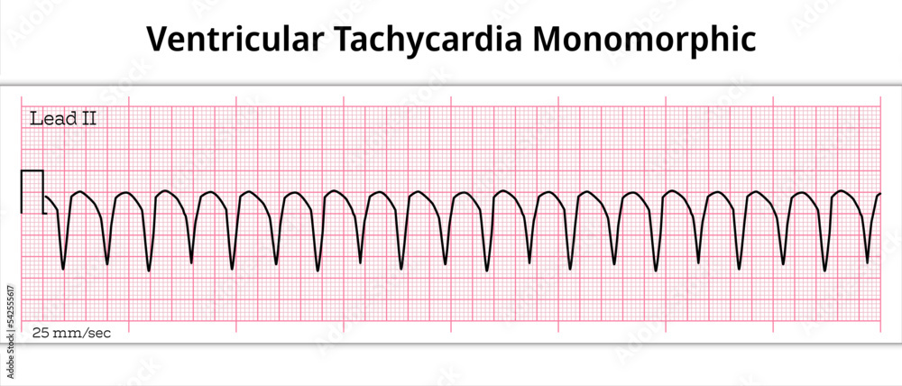 Vector de Stock ECG Ventricular Tachycardia – Monomorphic VT - 8 Second ...