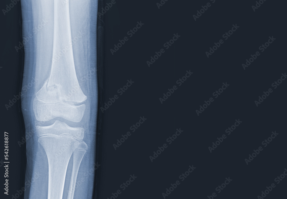 Film x-ray of human knee showing closed fracture,right distal femur ...