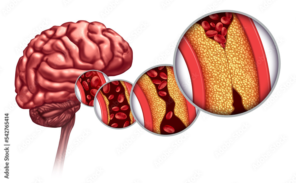 Atherosclerosis And Stroke as a Brain disorder caused by blood cells ...