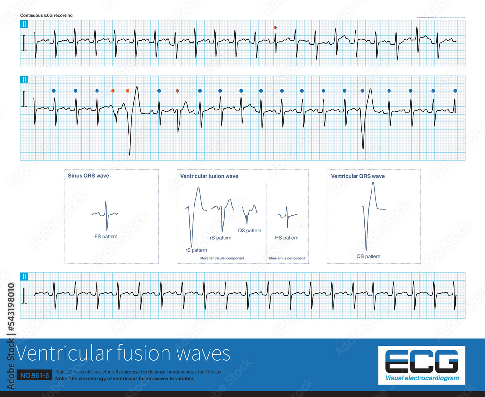 Ventricular precontractions in late diastole can be combined with sinus impulses to excite the ...