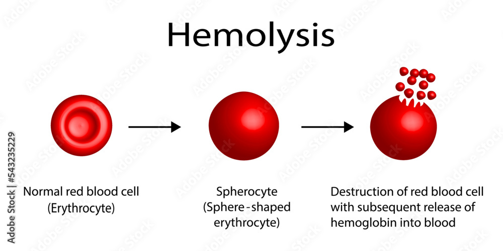 Stock-Vektorgrafik „Hemolysis. Normal red blood cell, spherocyte, then ...