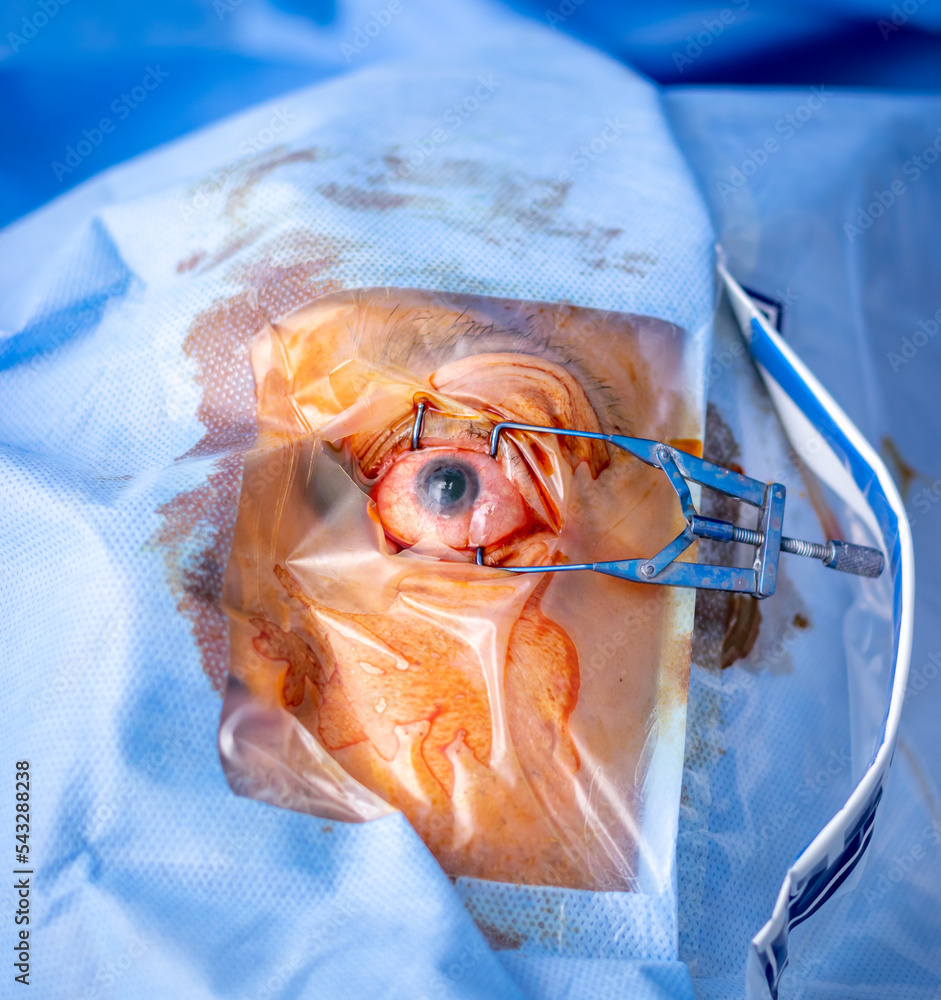 Foto Phacoemulsification, destruction of the opaque lens by ultrasound ...