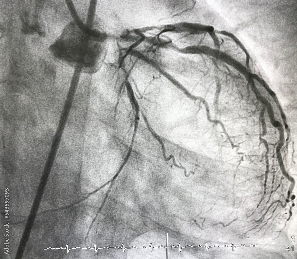 Coronary angiography shown left main (LM) stenosis with triple vessel ...