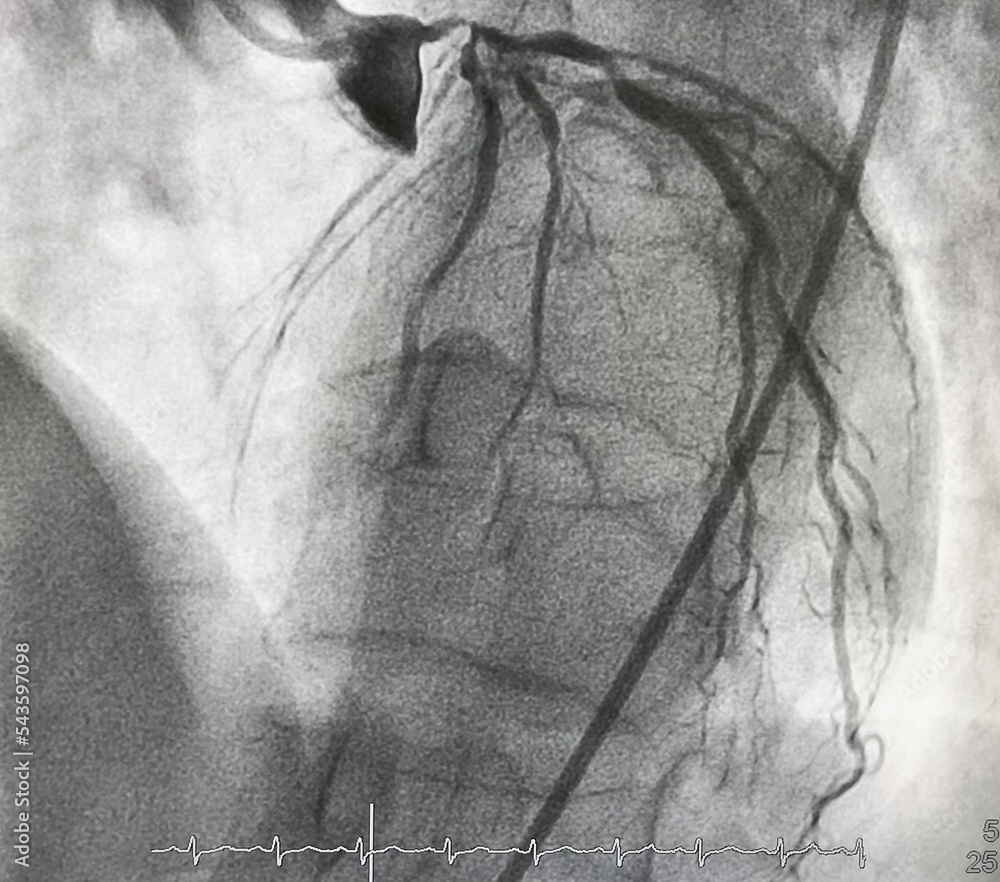 Coronary angiography shown left main (LM) stenosis with triple vessel ...