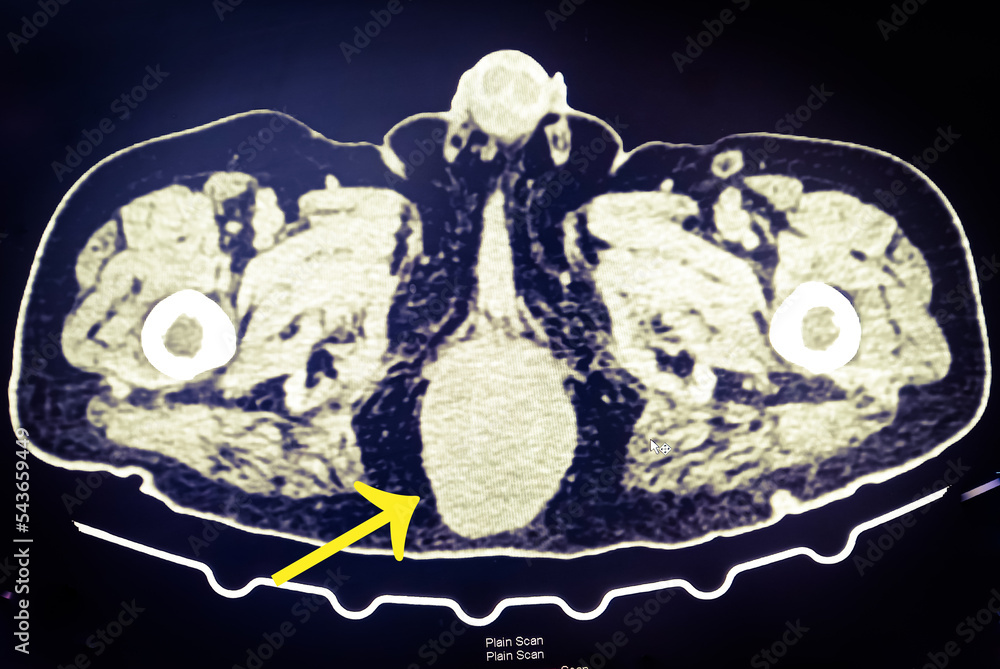 CT scan image of preanal or rectum abnormal growth, diagnosis Colon ...