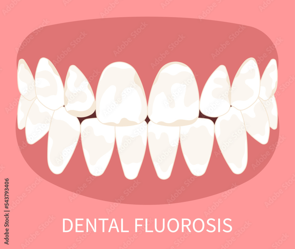 Turners Hypoplasia