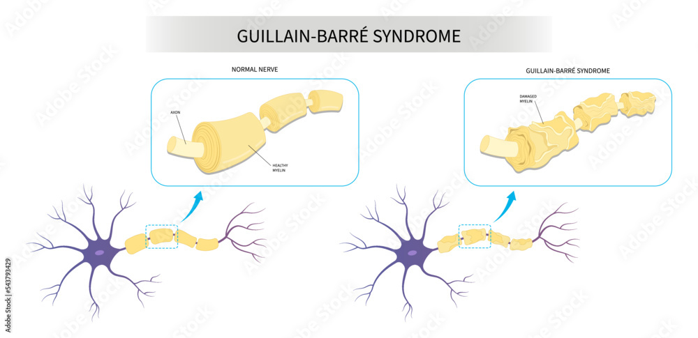 Vector de Stock Guillain Barré syndrome limb muscle autonomic numbness ...