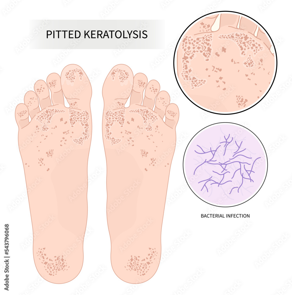 pitted keratolysis athlete's foot fungal heel wet cold skin toe ...