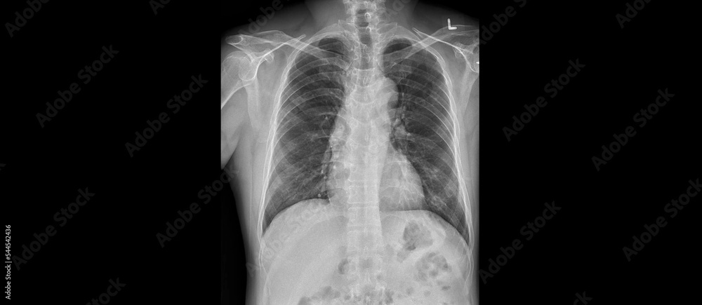 Chest x-ray image demonstrated heart, lungs, ribs, bones and muscles ...