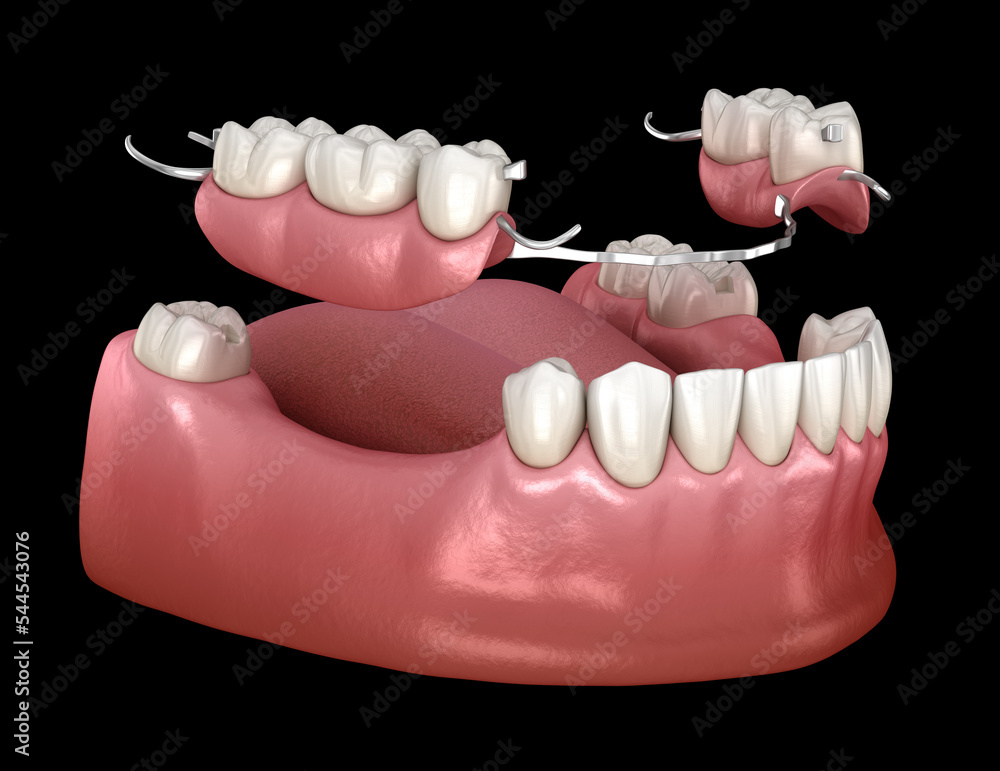Removable partial denture, mandibular prosthesis. Medically accurate 3D ...