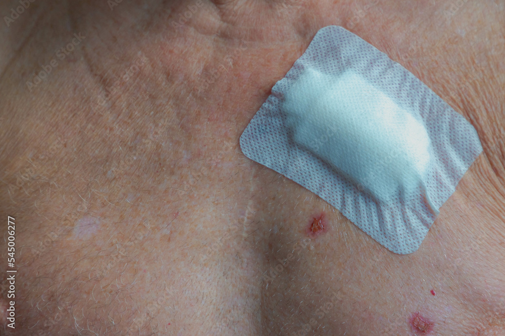 A man chest with Basal-cell carcinoma (BCC) also known as basal-cell ...