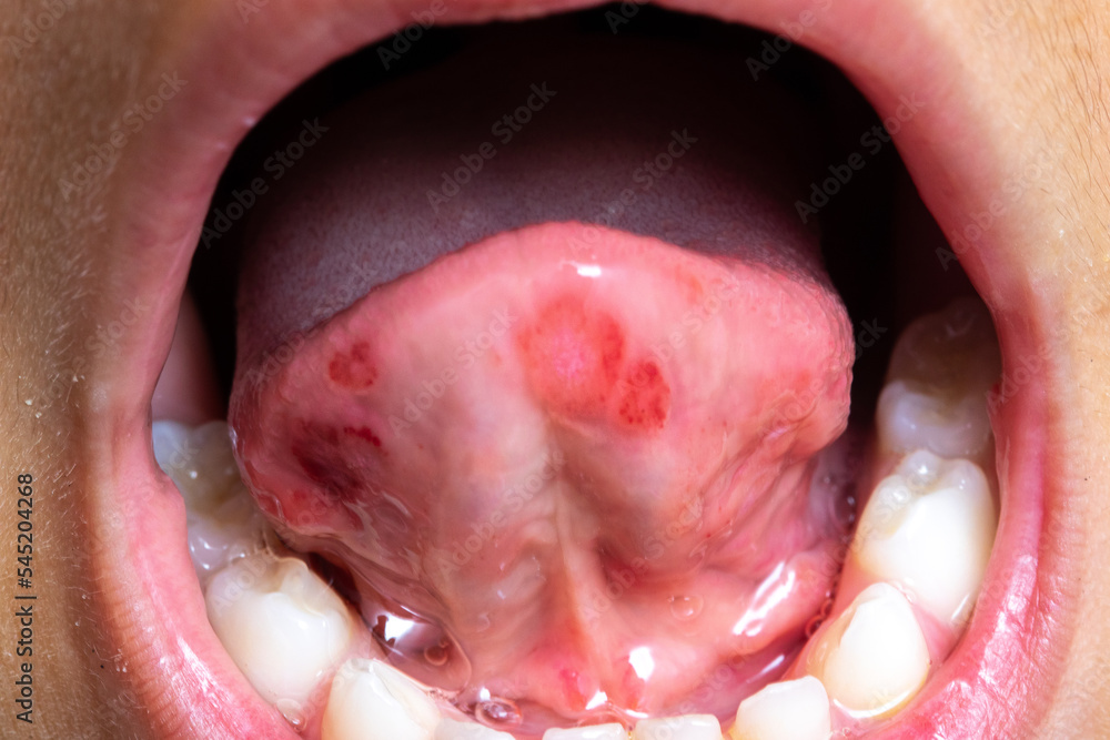 Tongue of a child with aphthous stomatitis. Widespread canker sores and ...