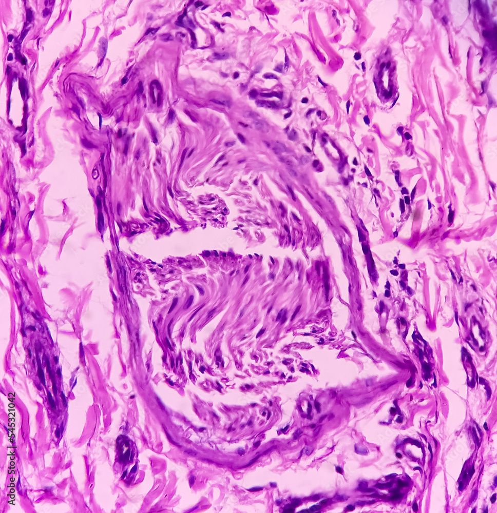 Prepatellar region histology: Chronic bursitis. light microscopic image ...