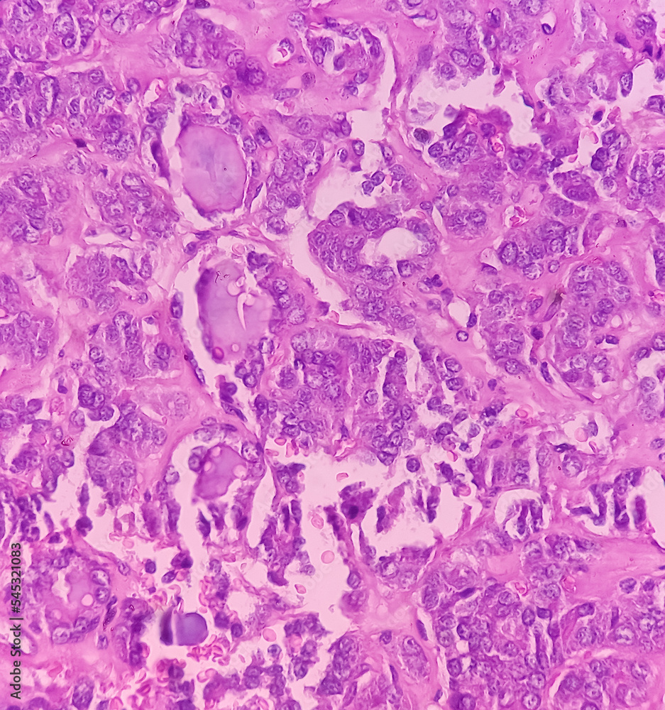 Follicular adenoma of thyroid gland, light micrograph. Histopathology ...