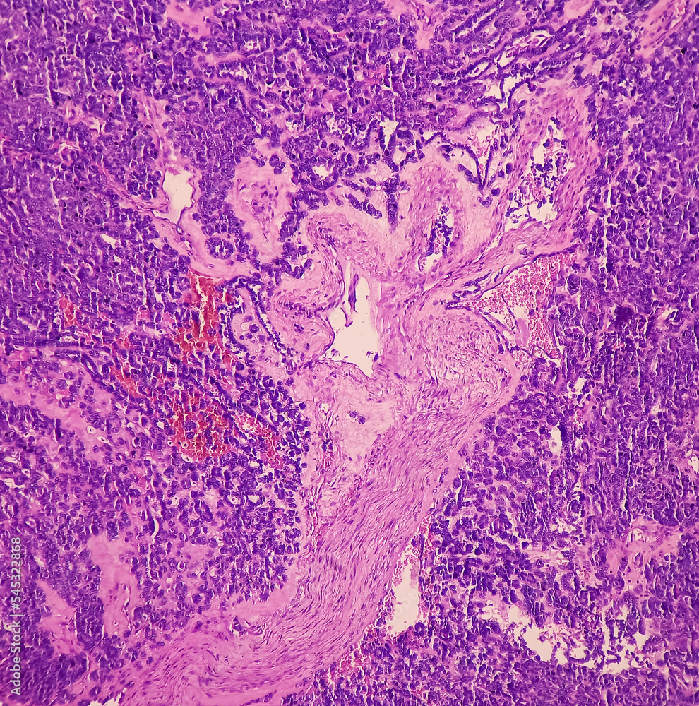 Thyroid cancer: Microscopic image of Follicular variant of papillary ...