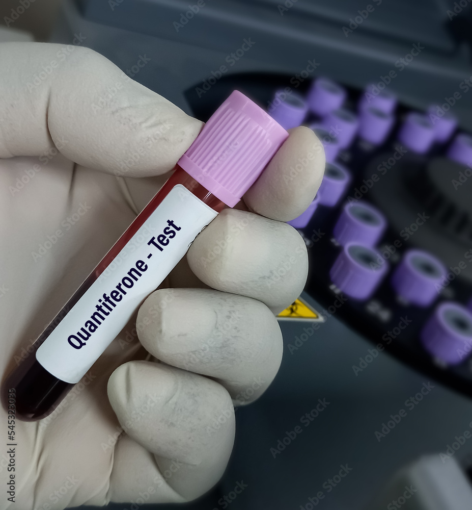 Test tube with blood sample for Quantiferone test, diagnosis for ...
