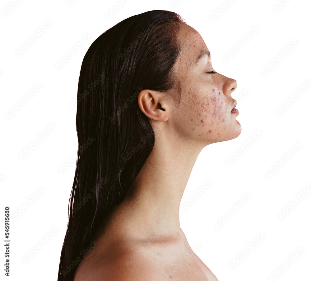 Young woman with inflammatory acne isolated on a transparent background ...