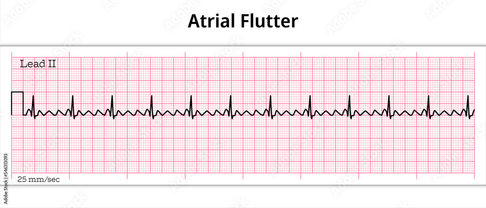ECG Atrial Flutter - 8 Second ECG Paper Stock Vector | Adobe Stock