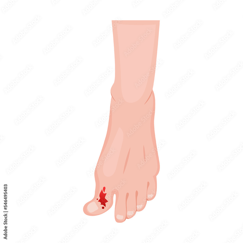 open fracture of toe, finger. Traumas of skin on body part. Vector ...