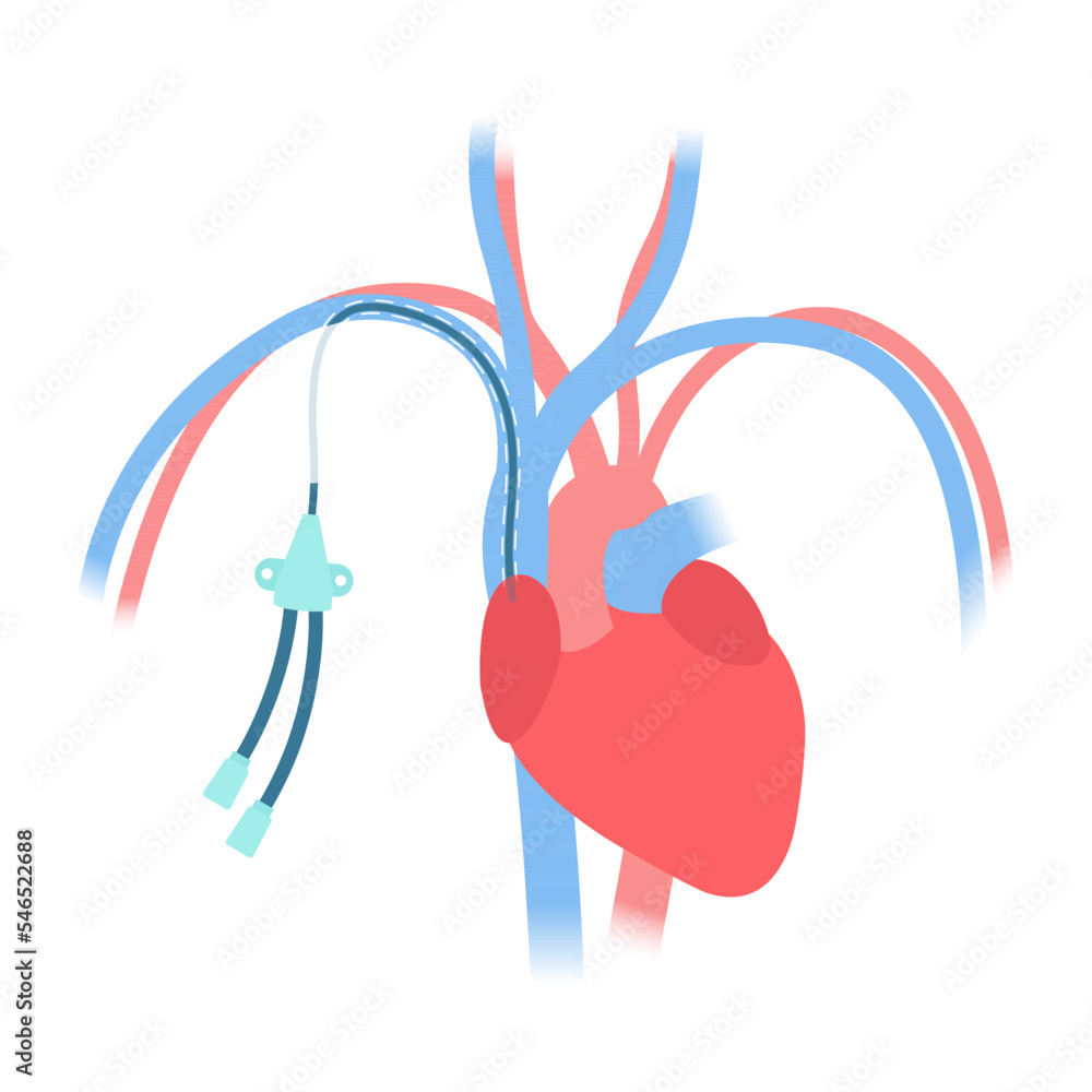 Tunneled central venous catheter placed in the subclavian vein. Patient ...