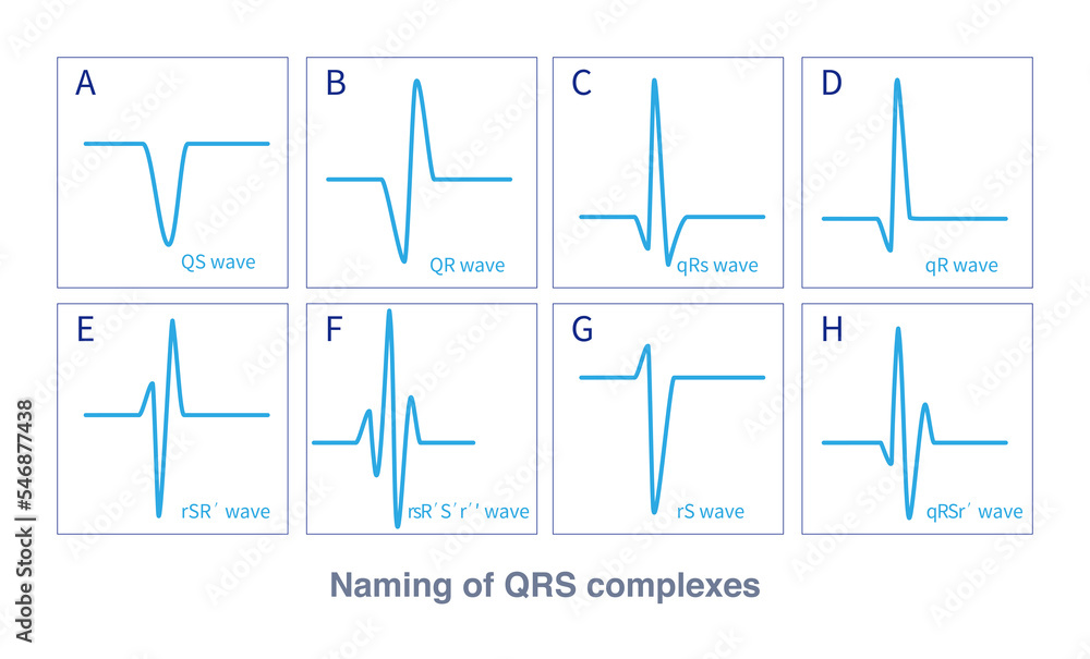 Illustration Stock QRS wave is an electrocardiogram wave formed by ...