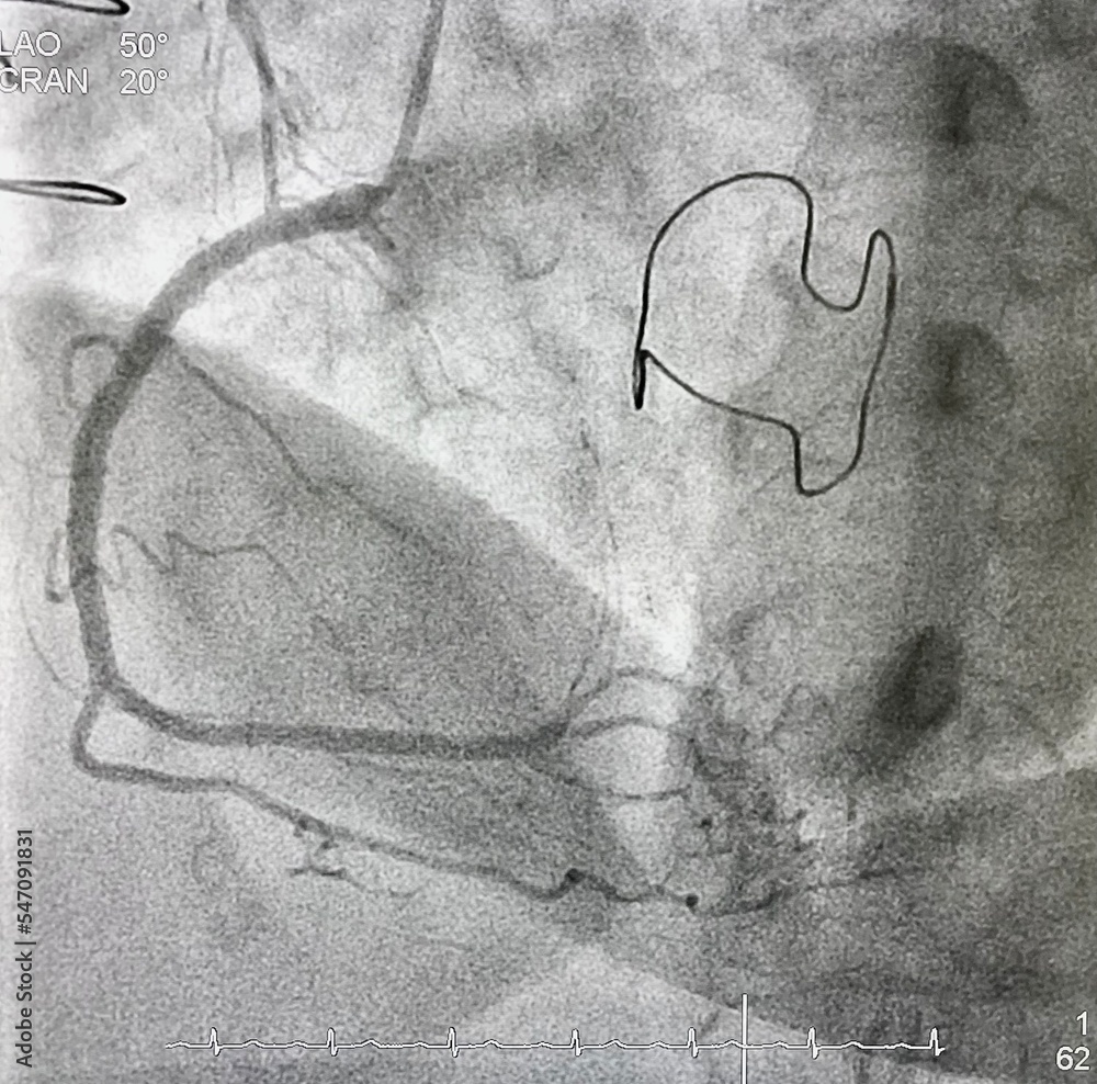 Coronary angiogram shown normal right coronary artery (RCA) with ...
