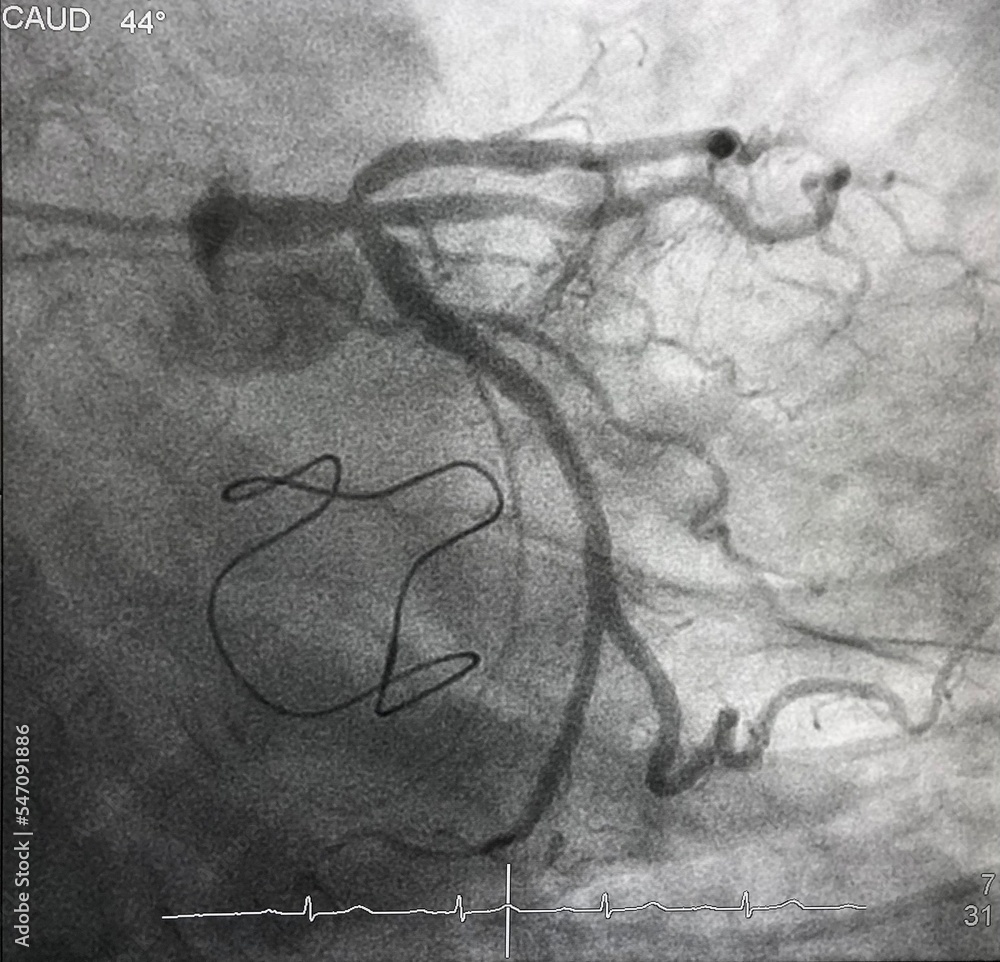 Foto de Stock Coronary angiogram shown normal left coronary artery (LCA ...