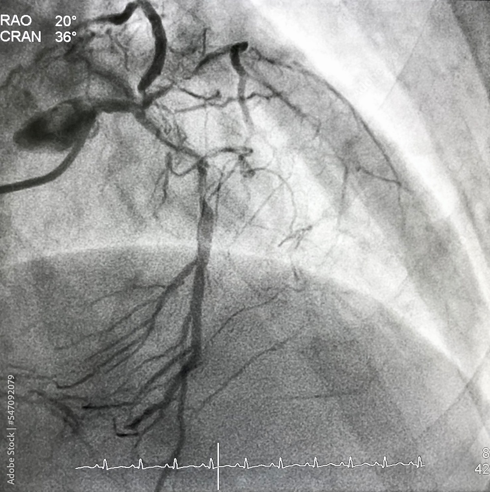 Стоковое фото «Coronary angiogram (CAG) shown chronic total occlusion ...