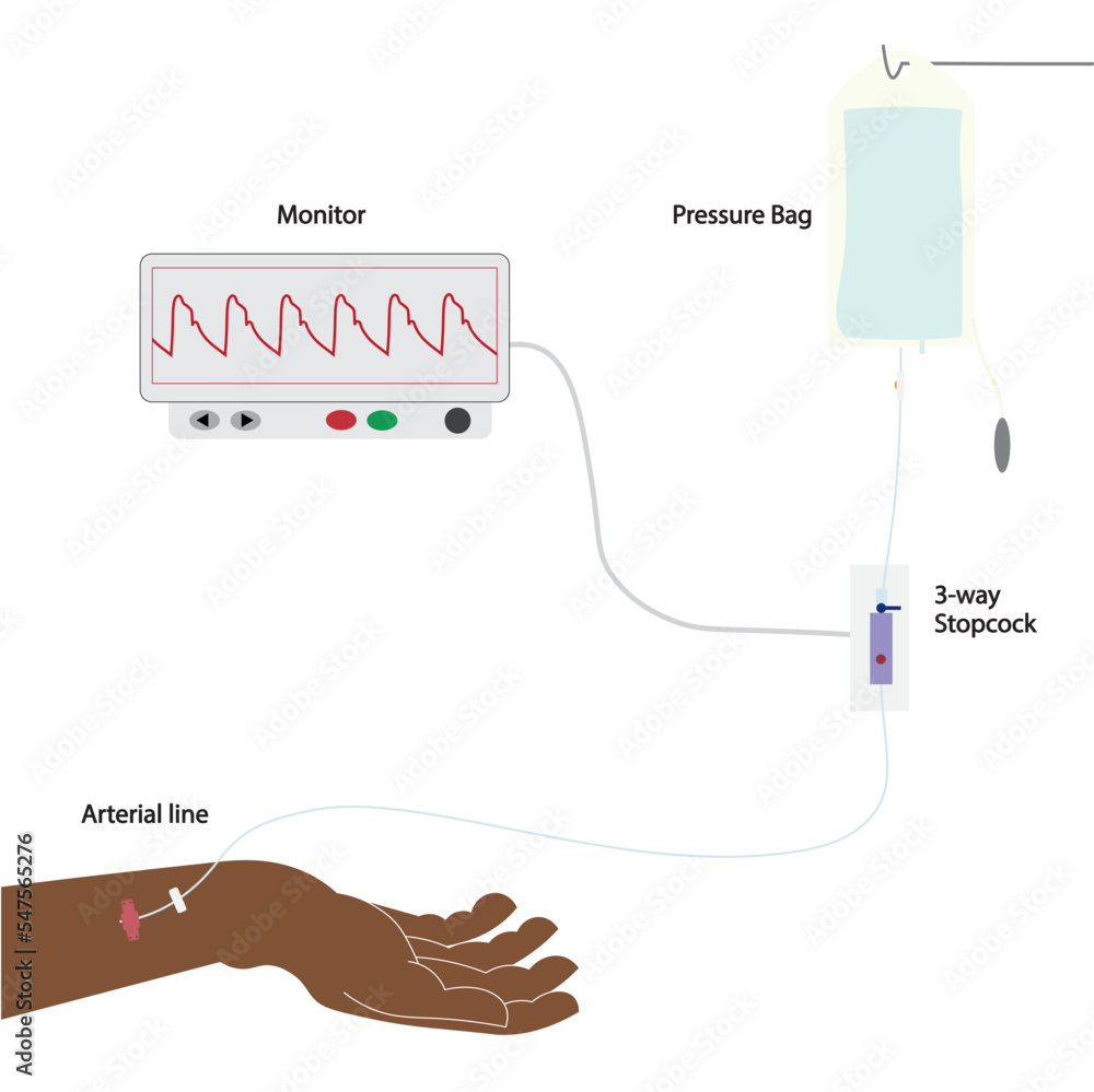 Invasive arterial blood monitoring system. Hand with an arterial line ...
