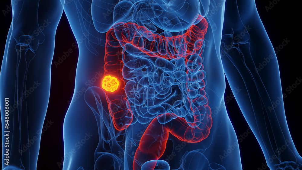 3D Rendered Medical Illustration of Male Anatomy - Colon Cancer ...