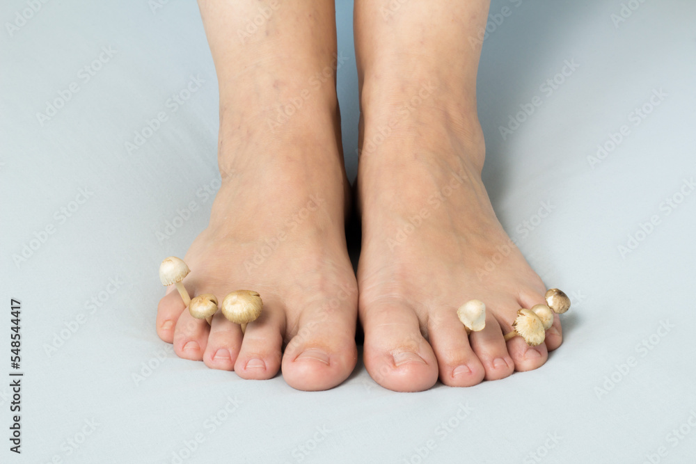 Fungi grow between the toes on the feet. Concept of nail fungus, skin ...