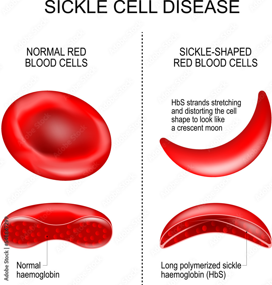 sickle cell disease. Stock Vector | Adobe Stock