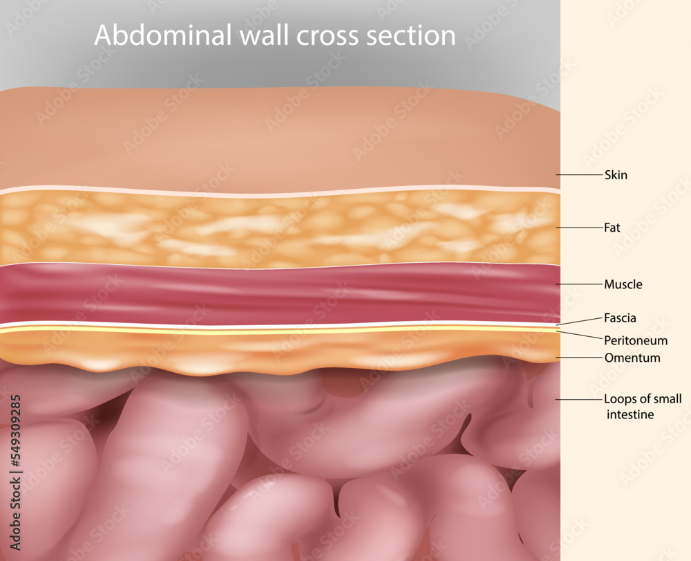 Abdominal wall cross section Anatomy. Abdominal wall layers Medical ...