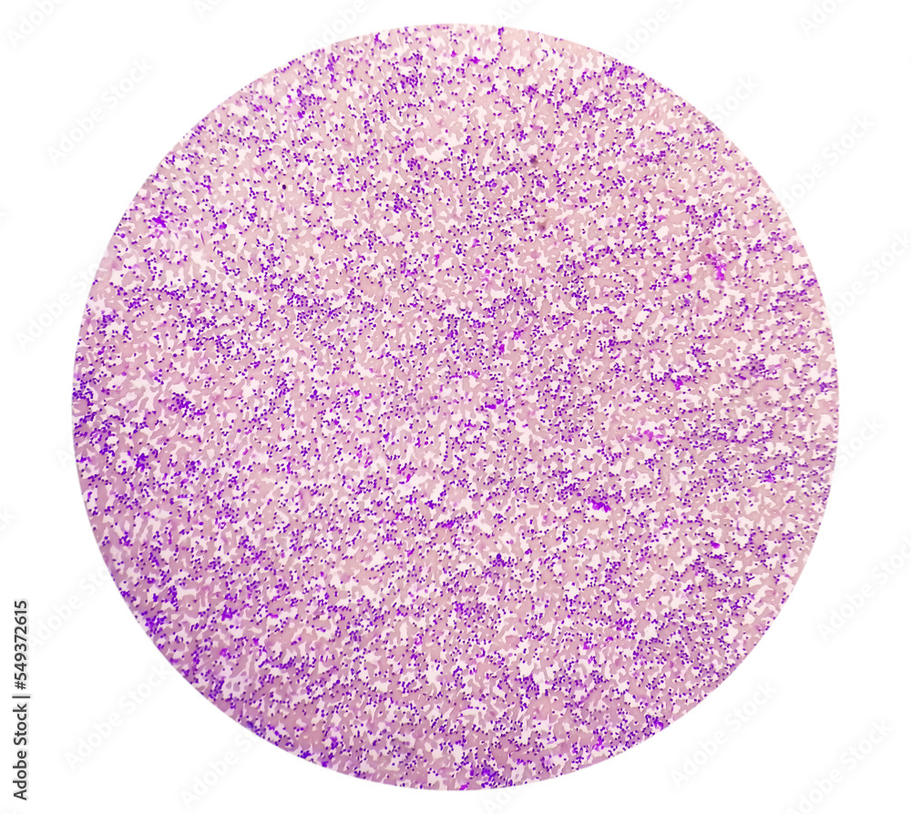 Blood smear under microscopy showing chronic lymphoblastic leukemia ...